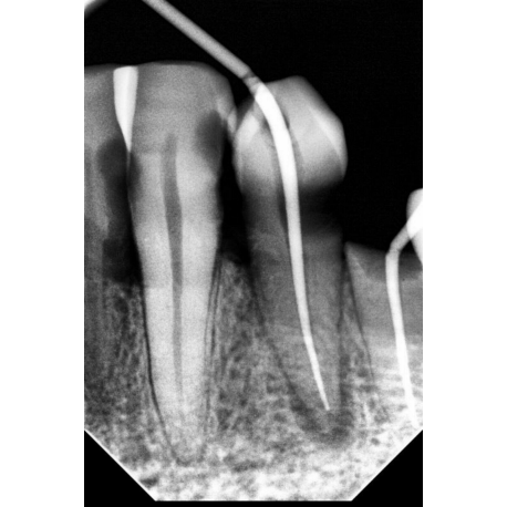 Paquete Radiovisiógrafo i-Sensor DBA + Rayos X Dental Portátil Ai Ray DBA